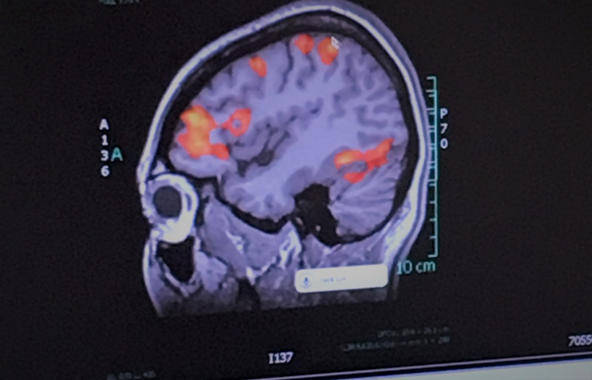 Epilepsy Options? Surgery, Technology, Oh My! – In Megan's Shoes